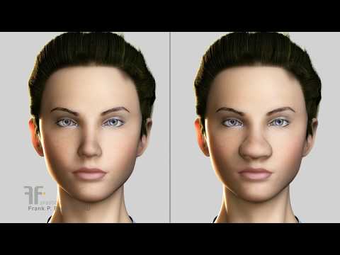 How To Reshape Bulbous Nasal Tip in Rhinoplasty; Boston Massachusetts Dr. Fechner