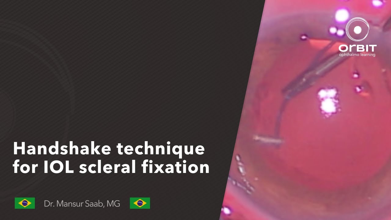 Handshake technique for IOL scleral fixation - YouTube