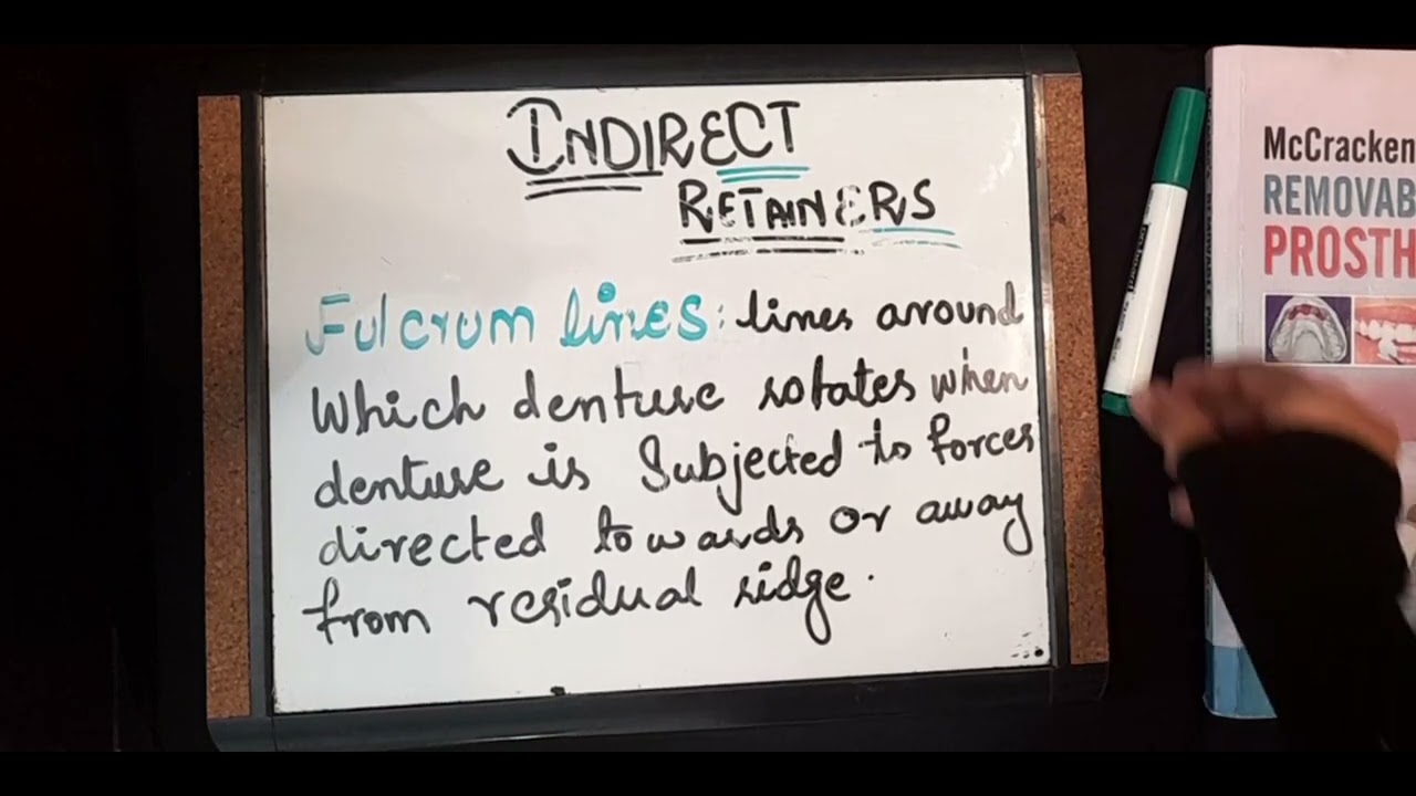 Fulcrum lines + location of indirect retainers (part 3) - YouTube