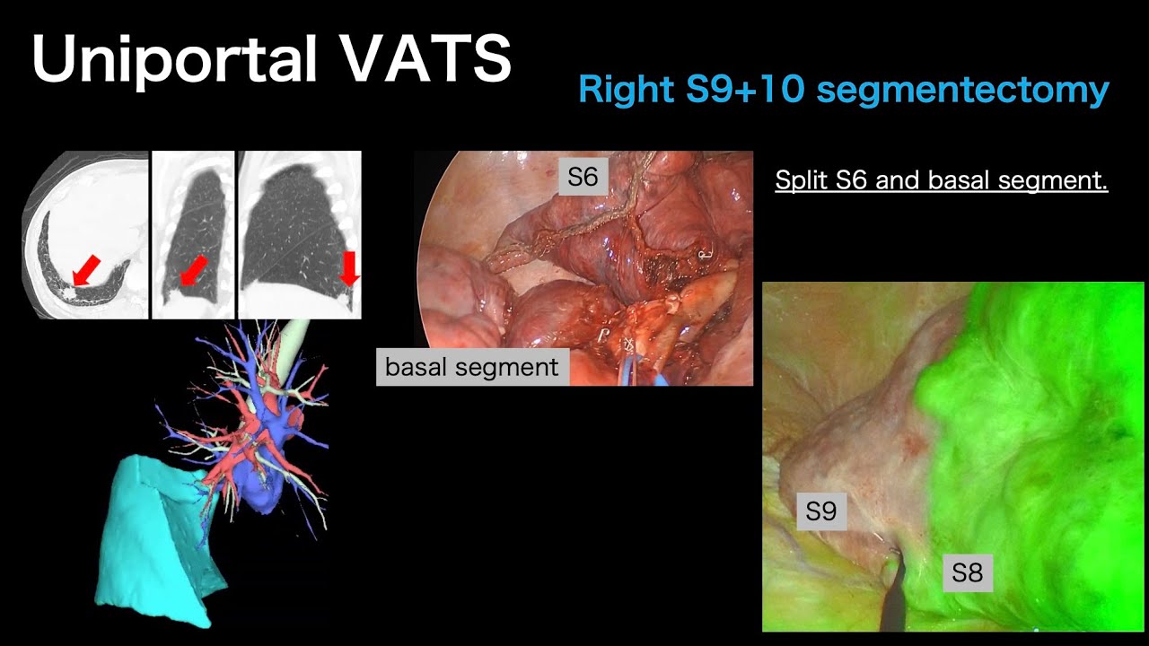115】Uniportal VATS rt. S9+10 segmentectomy with the lung separation of ...