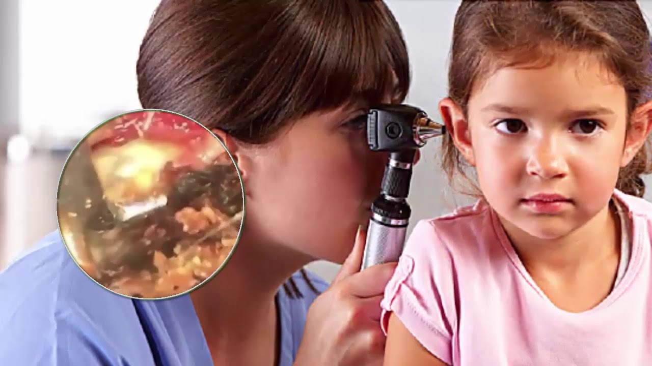 Removal Girl Ear Cleaning by Dr John Ear Care With Relaxing Music (Sad ...