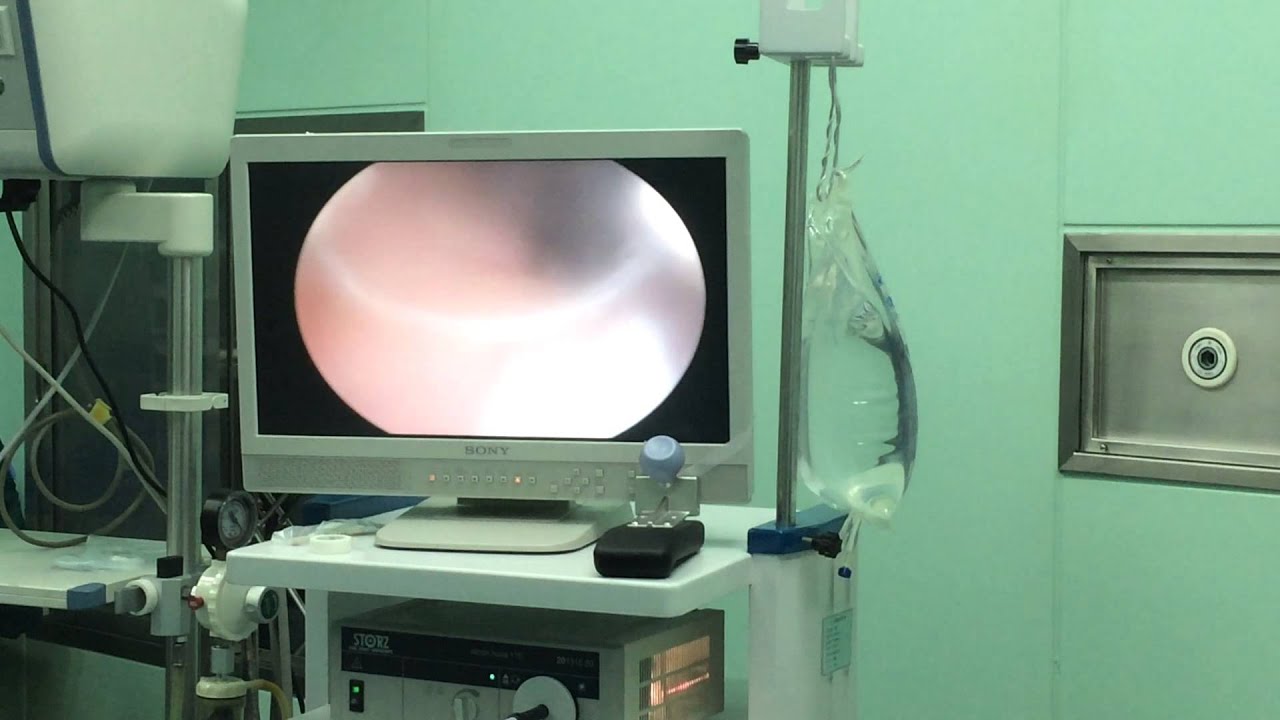 Mechan plasma surgery video for BPH - YouTube