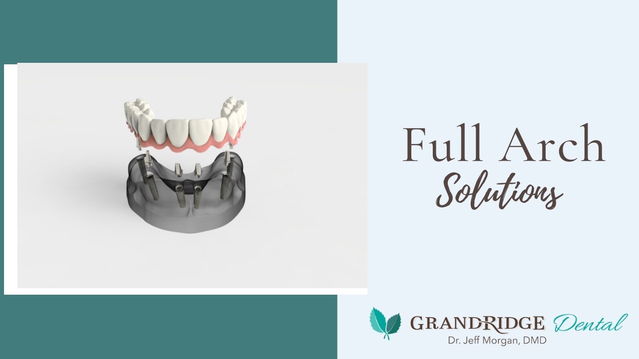 What Are Your Options for Full Arch Solution? - YouTube