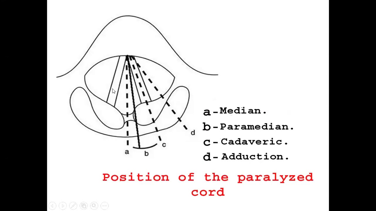 Vocal Cord Paramedian