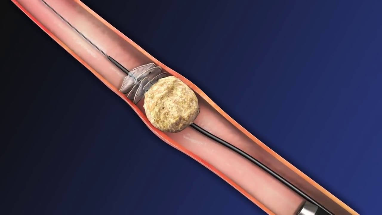 Ureteroscopic Stone Removal Apakah Yang Dimaksud Dengan Batu Saluran