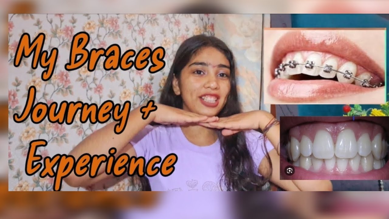 My first video after removing braces ☺️ My braces Journey + Experience ...