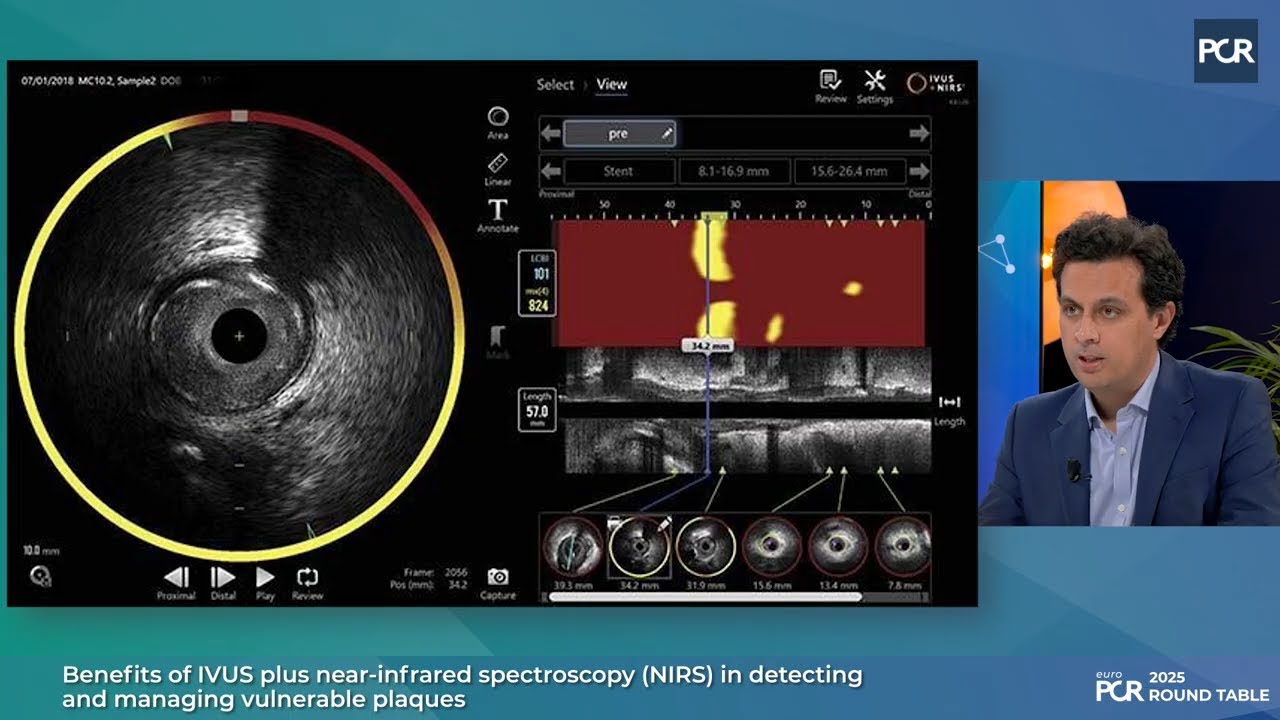 Benefits of IVUS plus near-infrared spectroscopy in detecting and ...