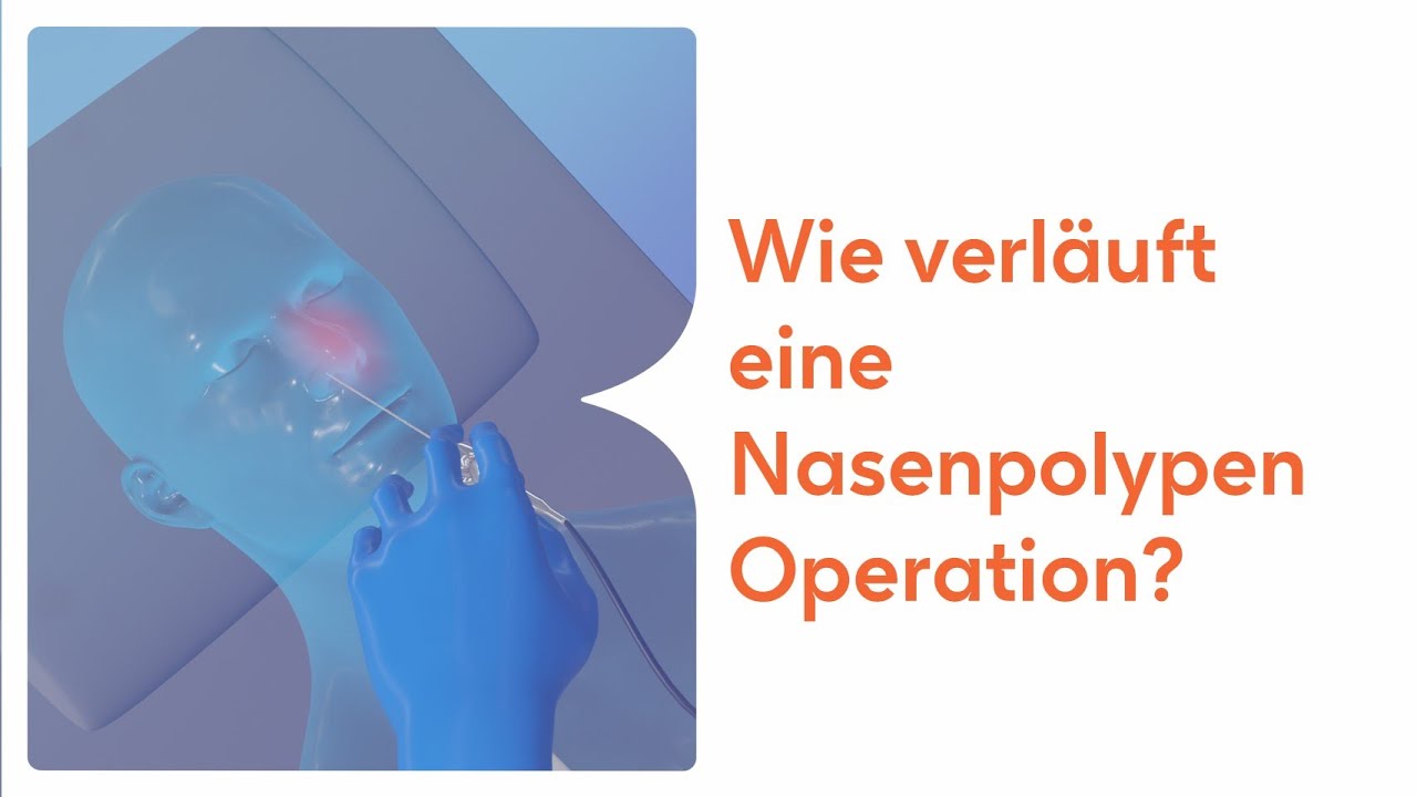 Wie verläuft eine Nasenpolypen Operation? - YouTube