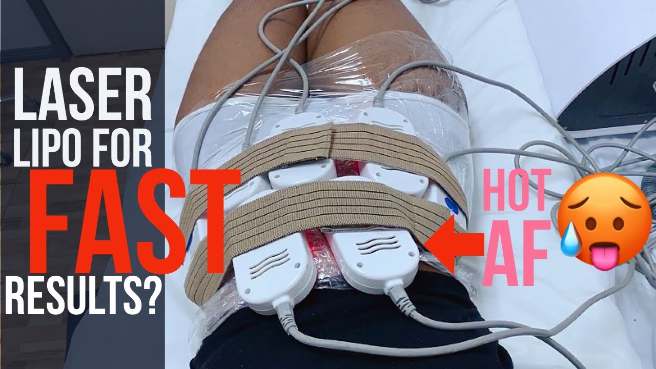 Vlog Laser Lipo For Fast Results Session 2 And 3 Ultrasound
