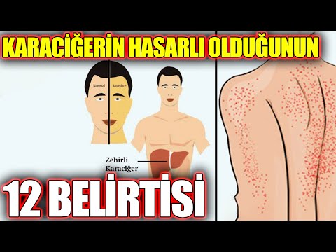 Karaciğerin Çalışmadığına Gösteren 12 Belirti Şunlar !
