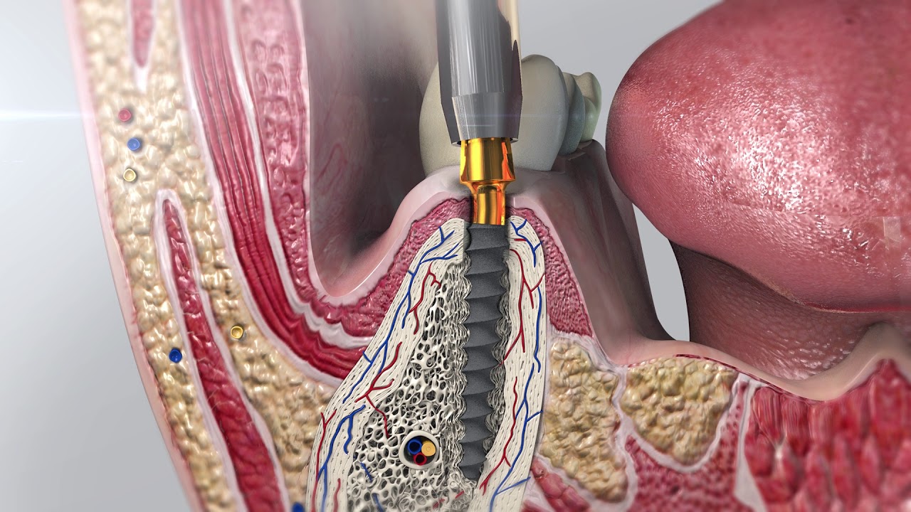 Implant Compressive. Protocol. - YouTube