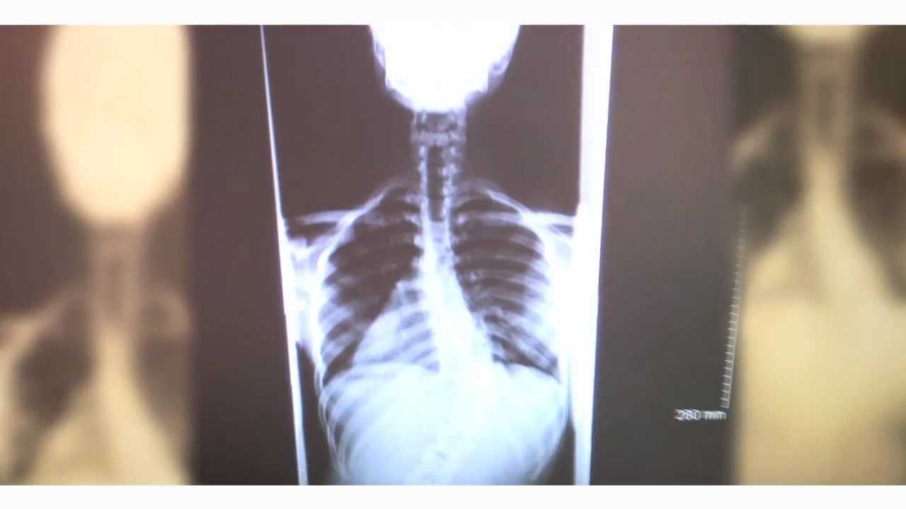 The importance of scoliosis screening - YouTube