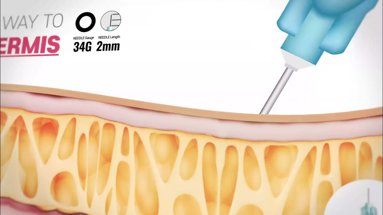 234-NEEDLEs : The easiest way to target DERMIS - YouTube