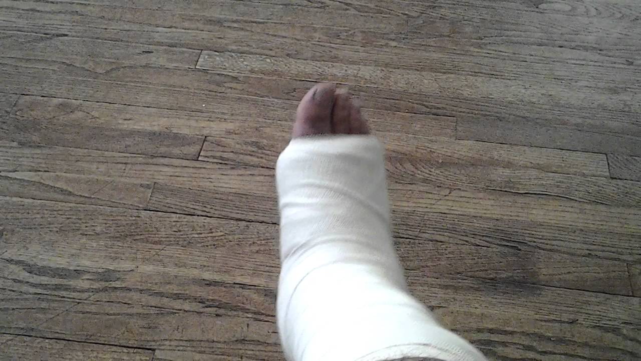 Soft leg cast - YouTube