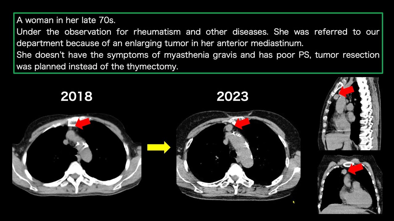 85】Uniportal VATS anterior mediastinal tumor resection via right-sided ...