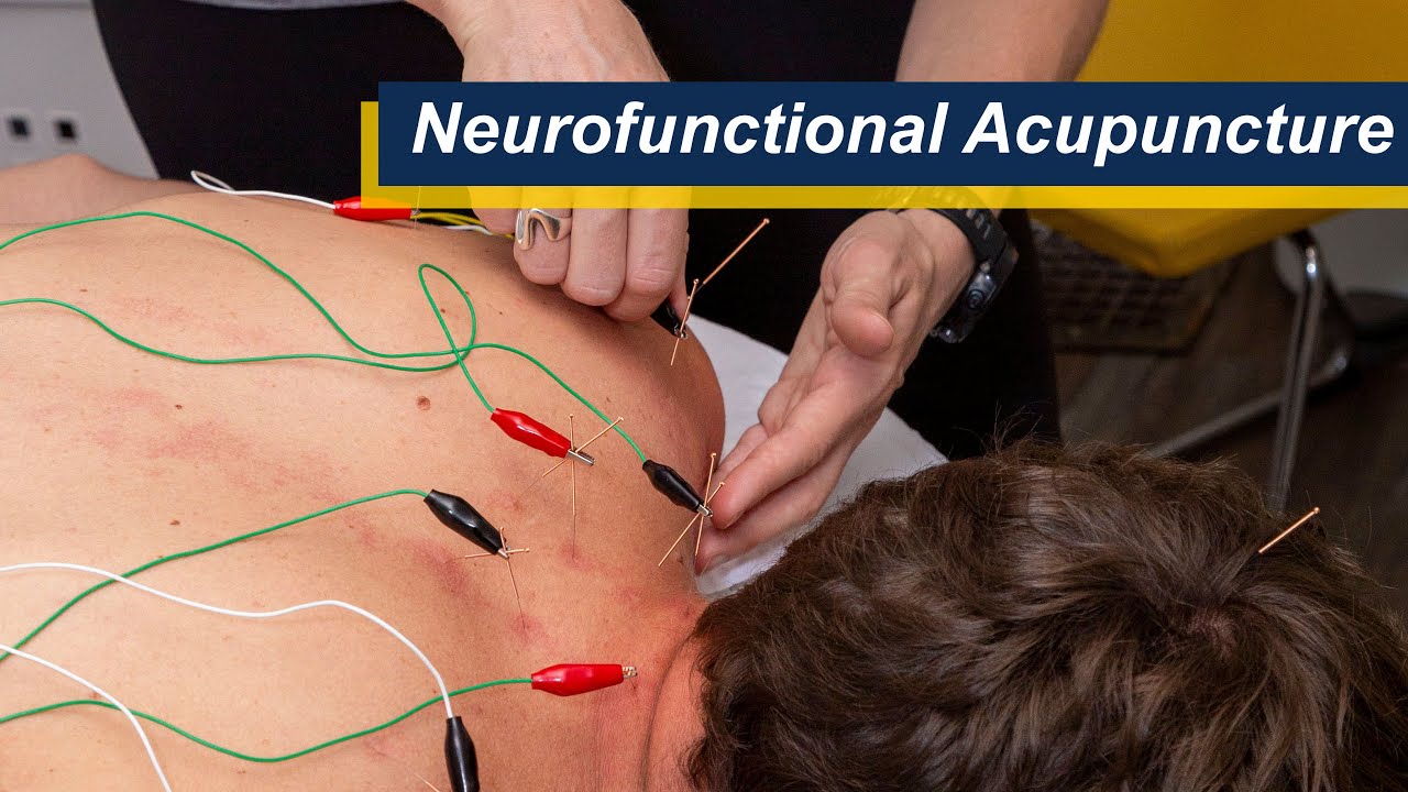 Neurofunctional Acupuncture | Instil Physio - YouTube