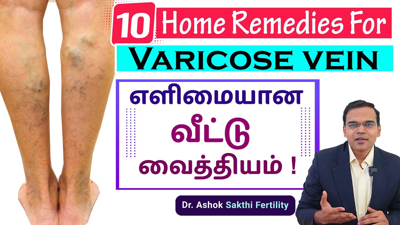 10 Home Remedies For Varicose Vein !! 10 எளிமையான இயற்கை வீட்டு ...