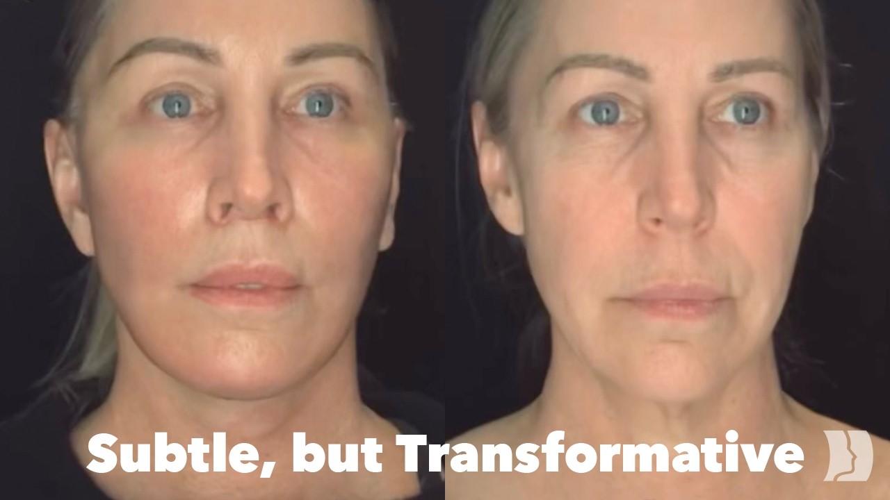 Subtle Changes Can Be Transformative – Amazing Facial Plastic Surgery ...