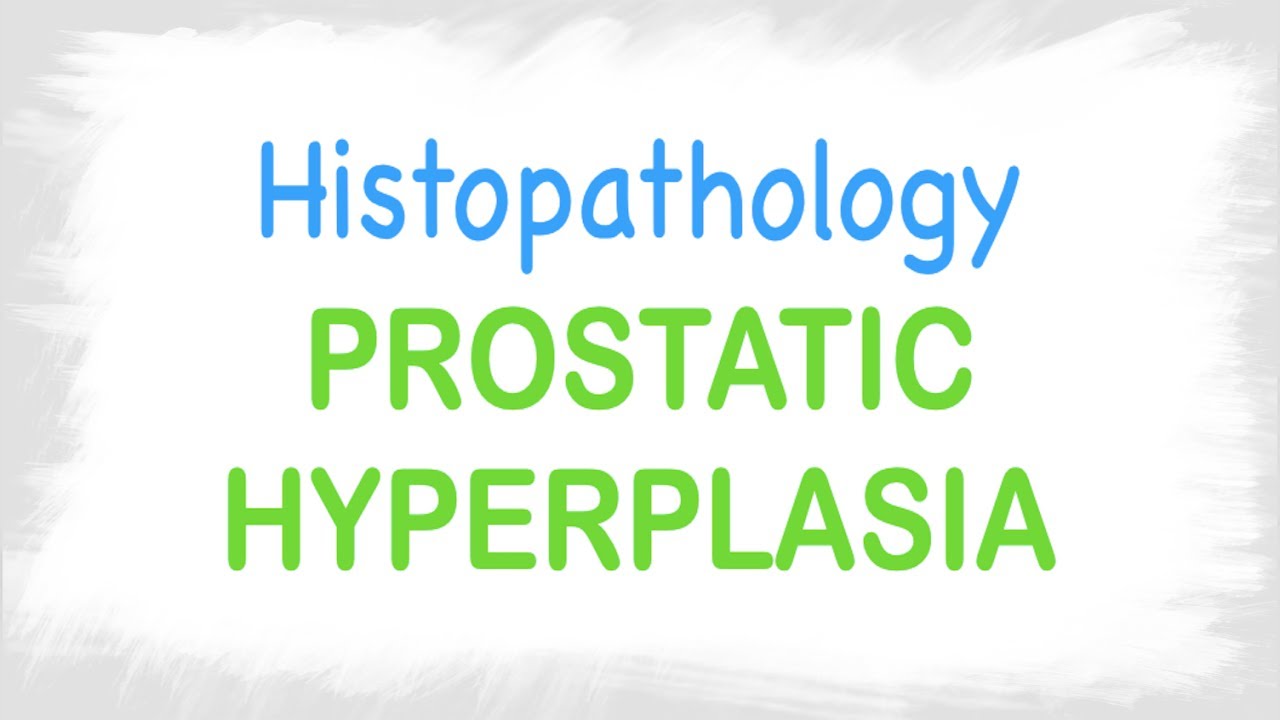 Senile prostatic hyperplasia histopathology features - YouTube