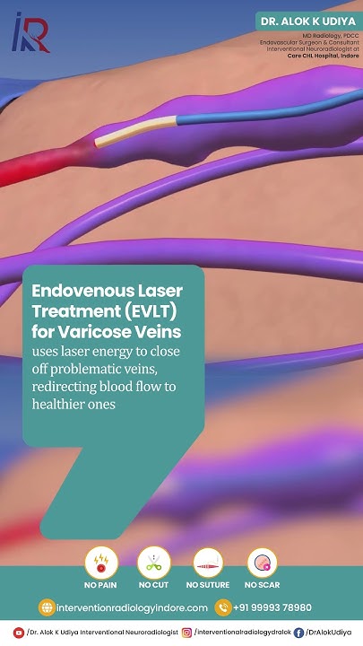 Minimally Invasive Solution For Varicose Veins Endovenous Laser