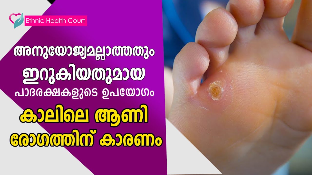 അനുയോജ്യമല്ലാത്തതും ഇറുകിയതുമായ പാദരക്ഷകളുടെ ഉപയോഗം കാലിലെ ആണി ...