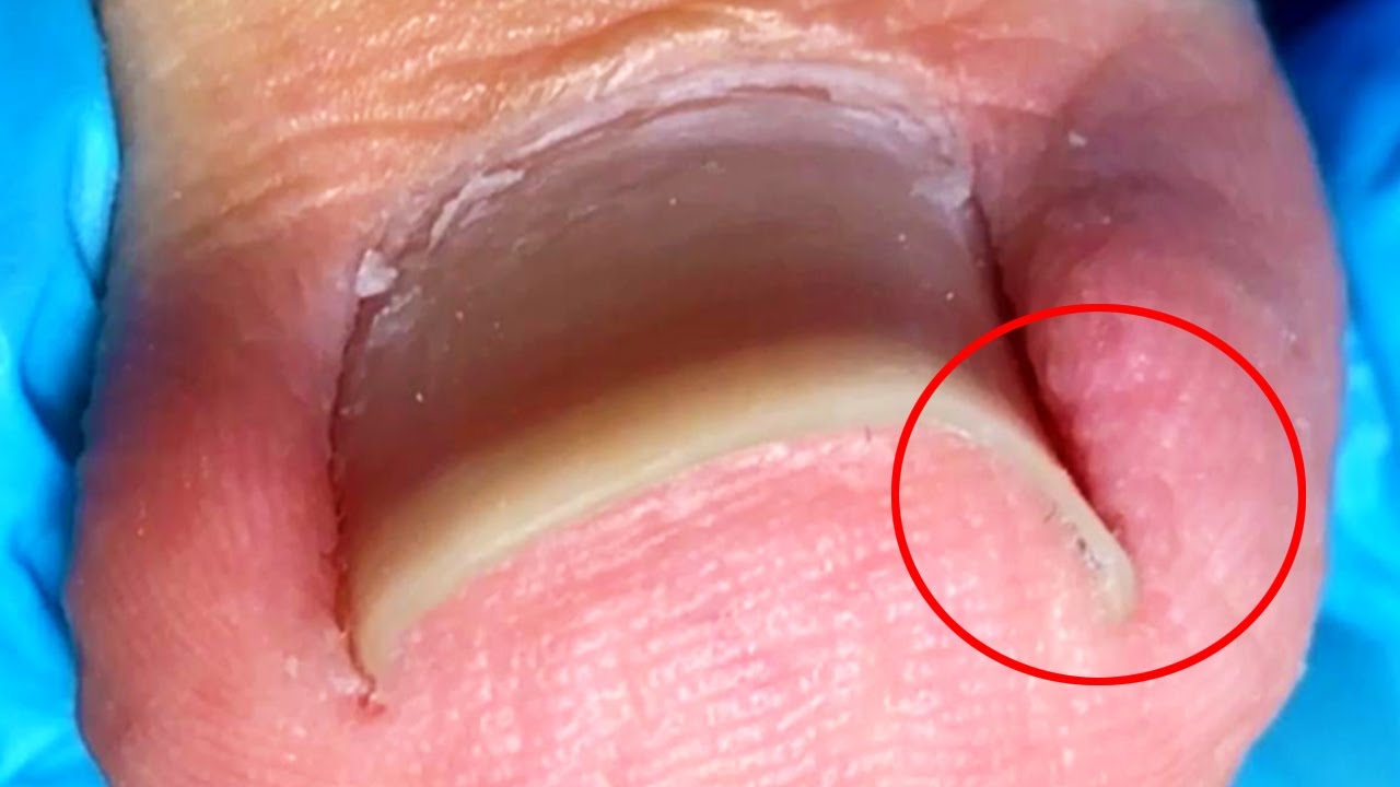 Super obvious ingrown toenail, completely repaired【Crazy pedicure room ...