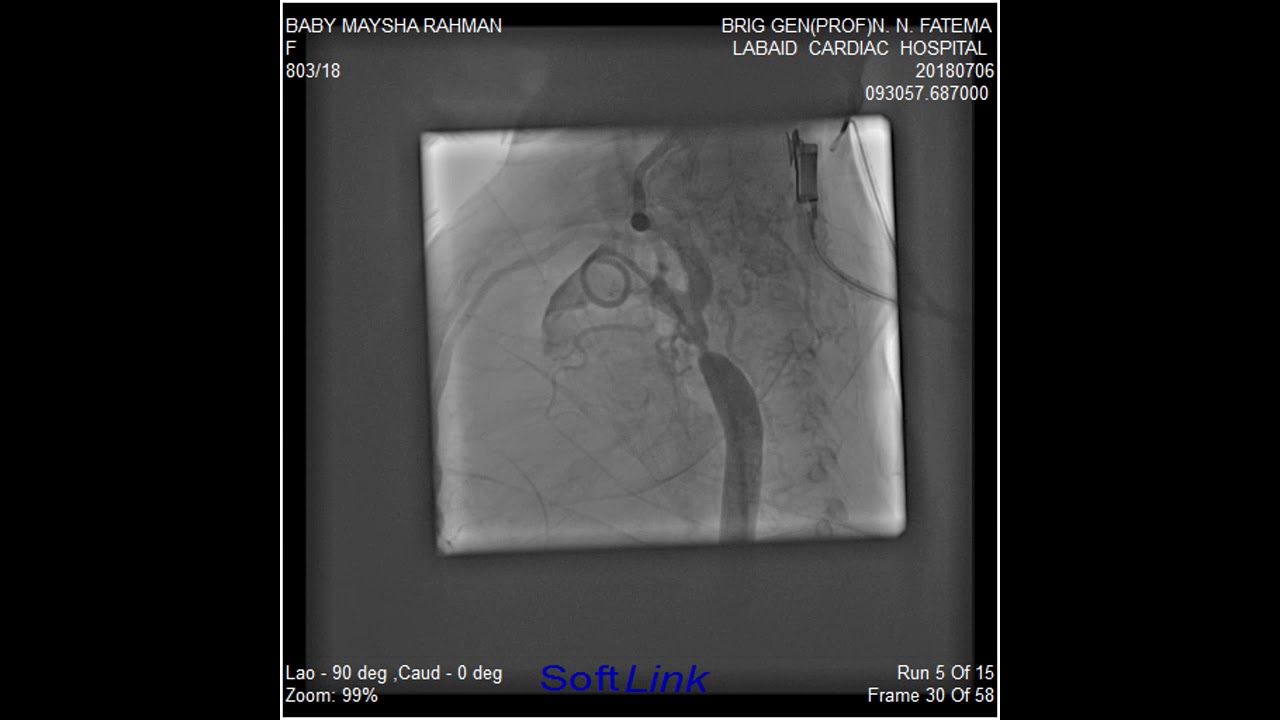 Baby Mayisha 06 M 3 5 Kg Severe COA Aortogram Angio show - YouTube