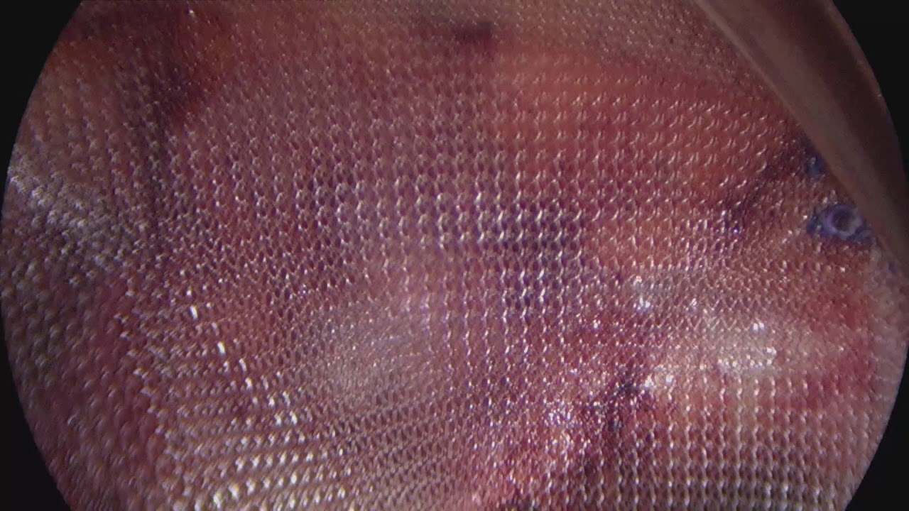 Herniorrafia Inguinal videolaparoscópica - YouTube