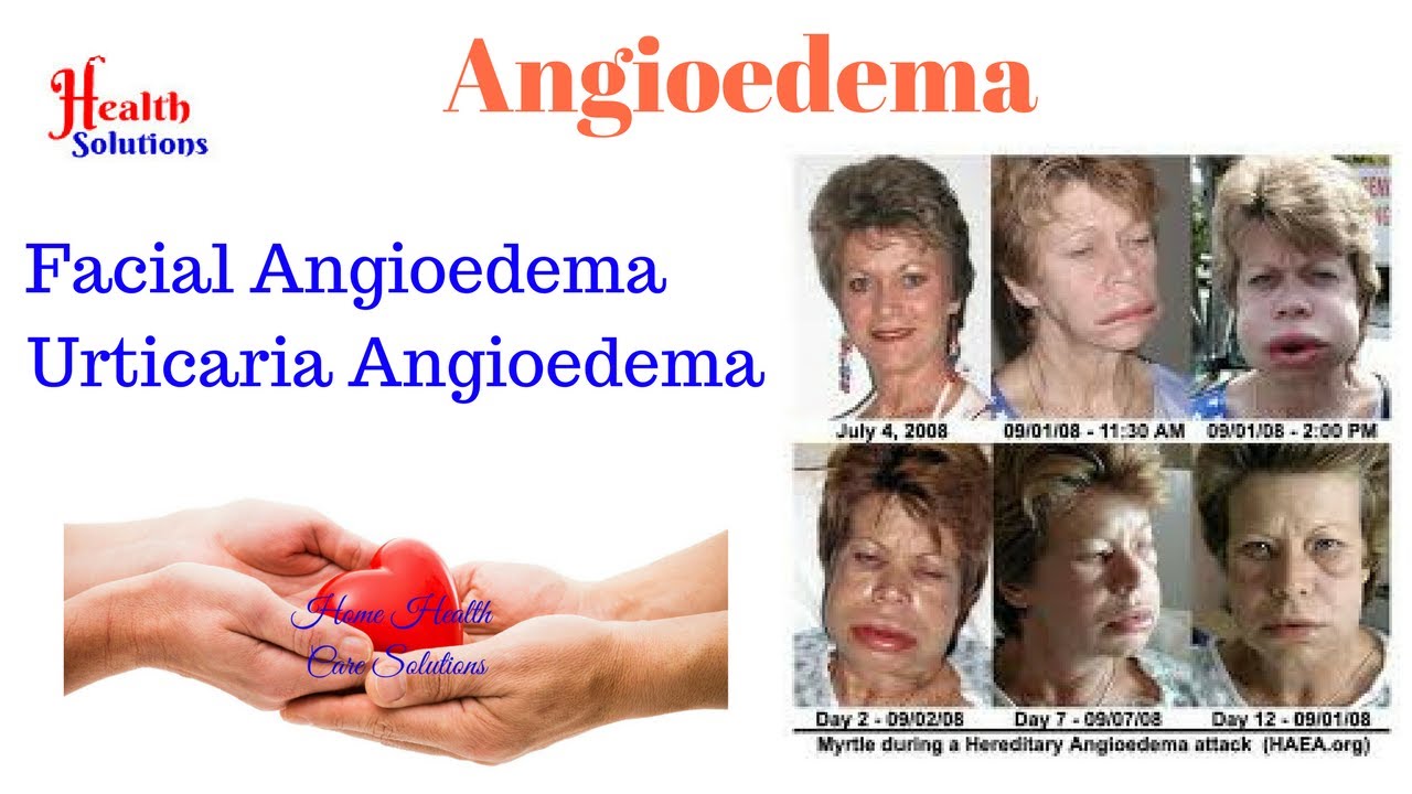 Angioedema - Facial Angioedema - Urticaria Angioedema - YouTube