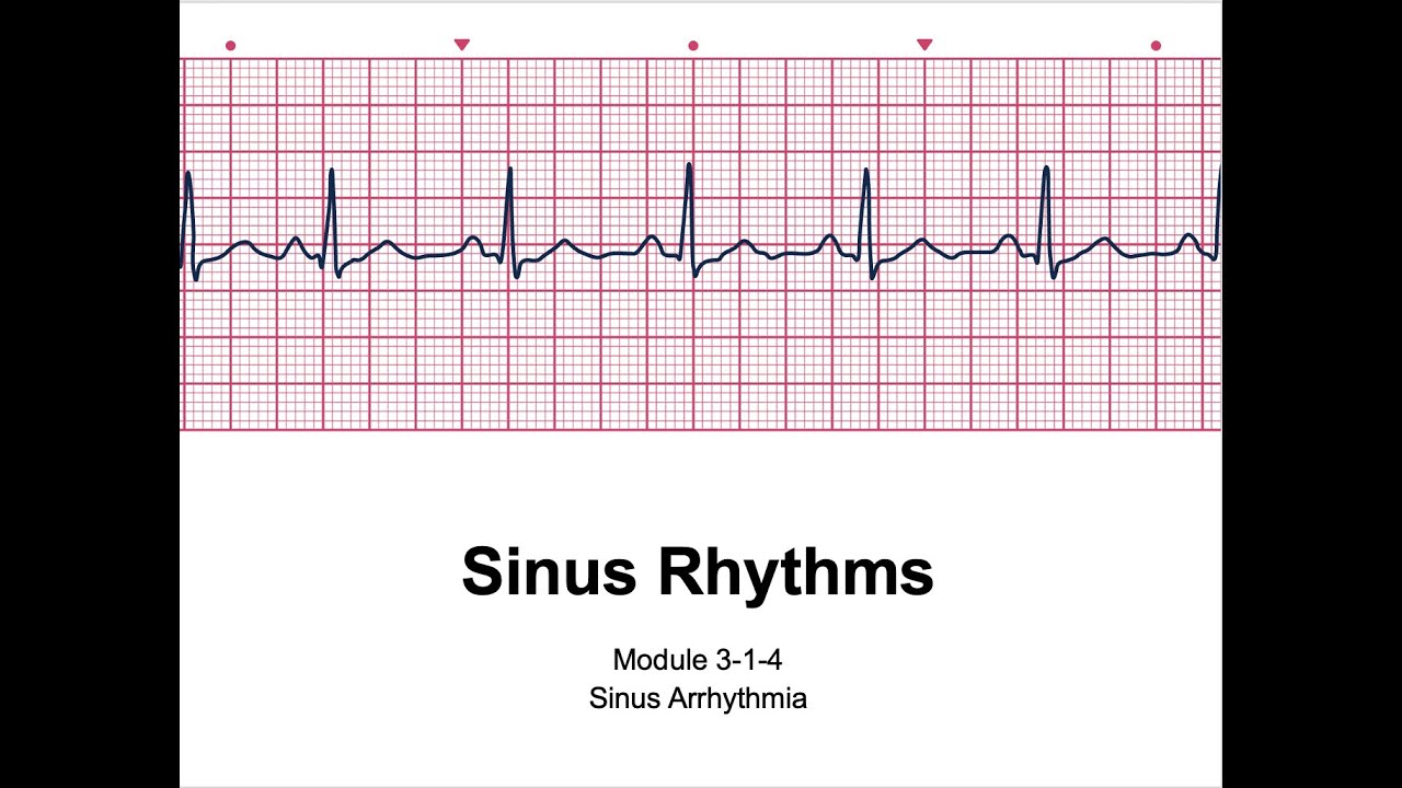Paramedic Cardiology Module 3-1 Lecture 4: Sinus Arrhythmia - YouTube