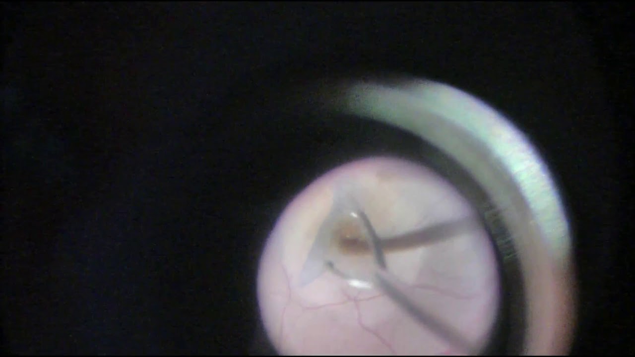 Macular hole Surgery temporal inverted ILM flap - YouTube