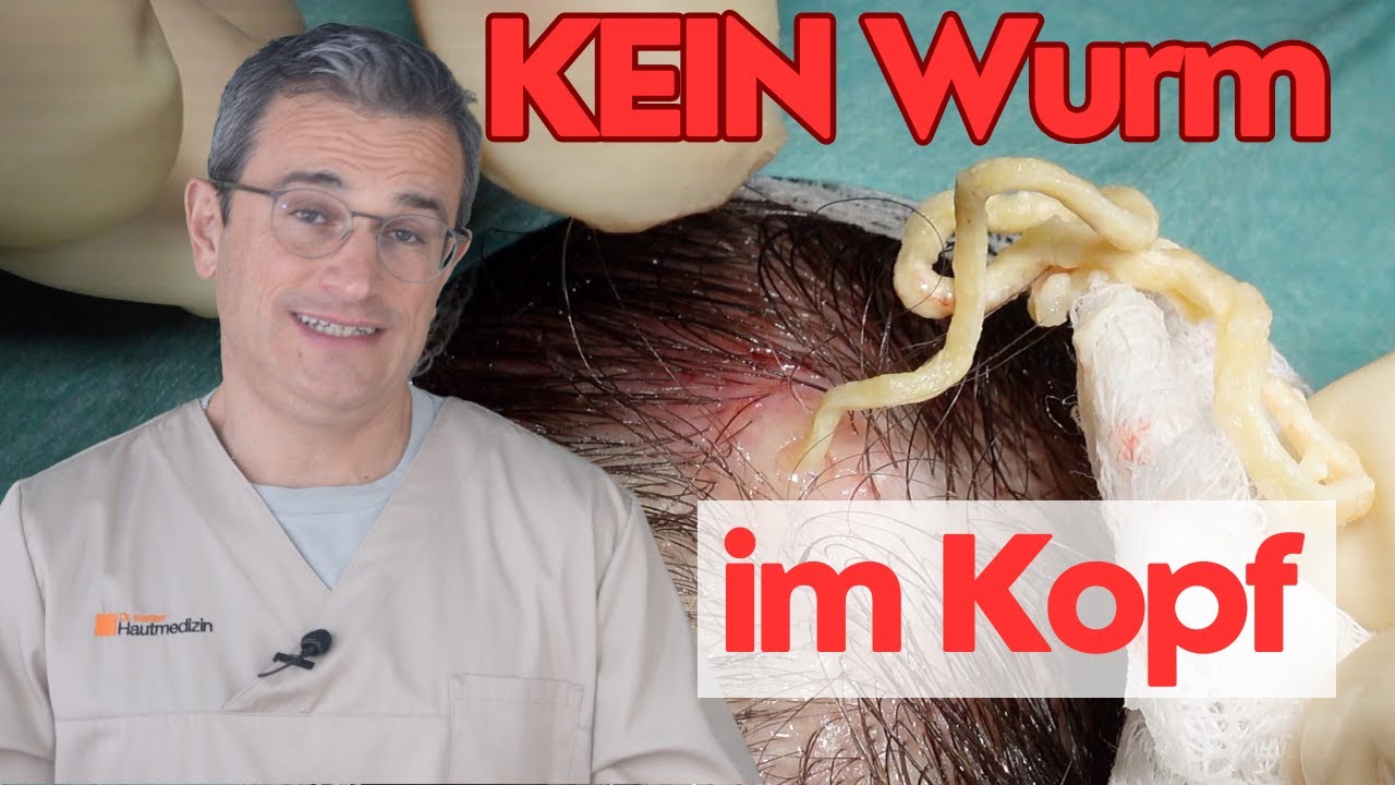 Revolutionäre Trichilemmalzysten-Entfernung: Minimalinvasiv & Effektiv ...