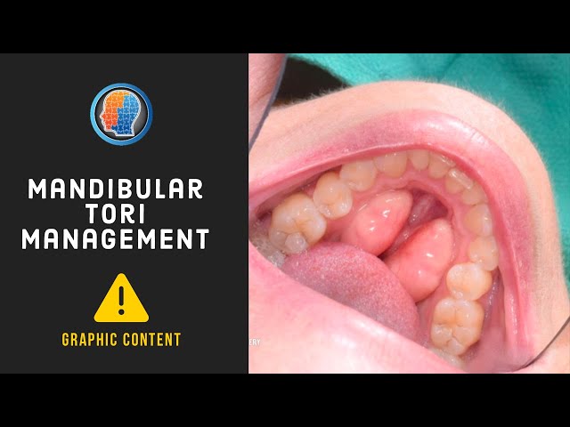 Torus Mandibularis Removal
