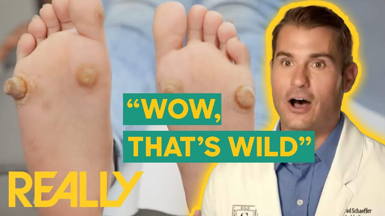 Dr. Brad Is Blown Away By EXTREME Foot Growths! | My Feet Are Killing ...