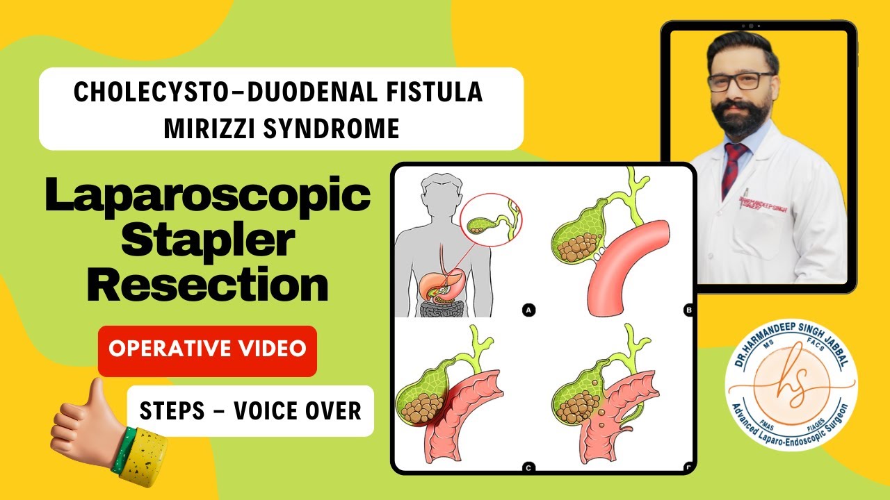 Cholecysto-Duodenal Fistula + Mirizzi Syndrome - Laparoscopic Stapler ...