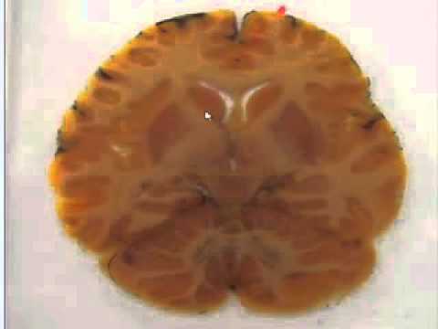 Transverse section of the brain (Neuroanatomy Slide) - YouTube
