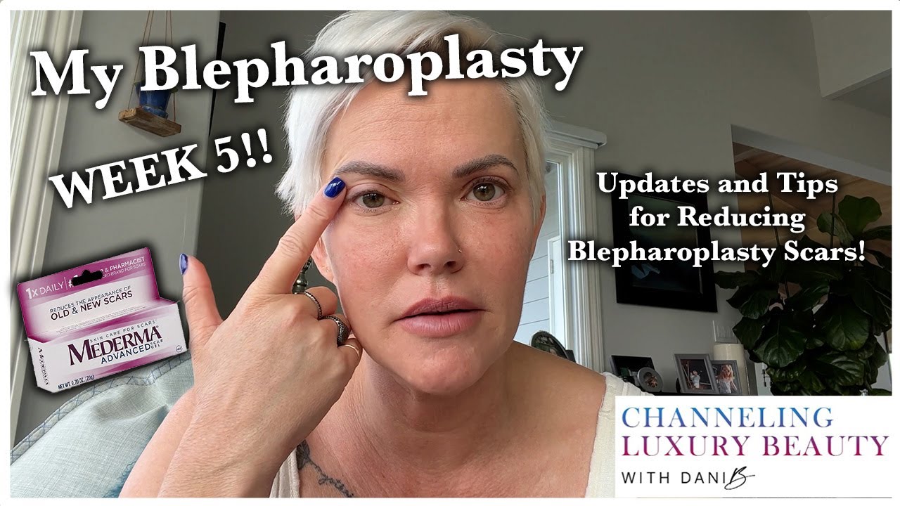 Blepharoplasty Update Week 5! Scars, Recovery, Bruising, Update Eyelid ...