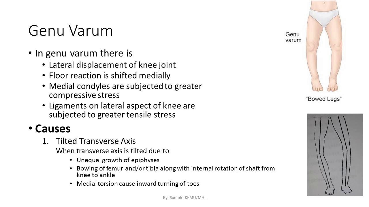 genu valgum, genu varum, genu recurvatum - YouTube