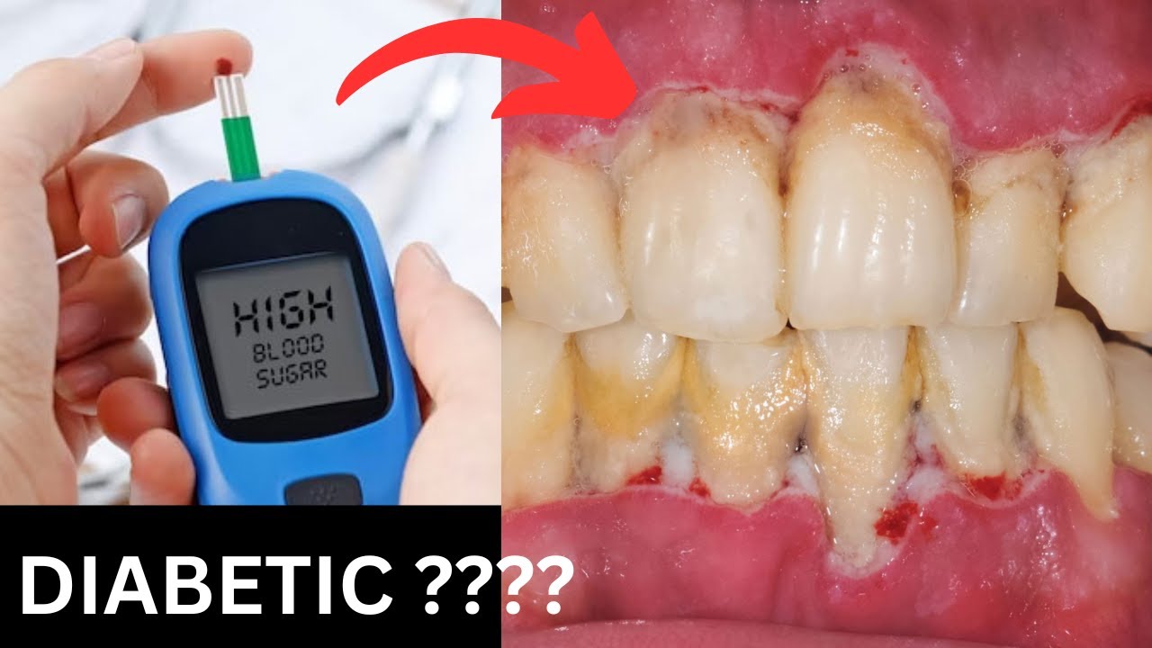 How diabetes affects your gums ? | If you are diabetic - Watch this ...