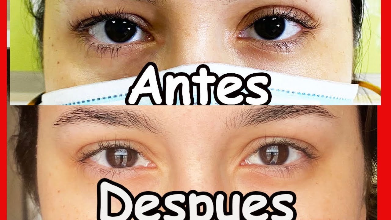 HOW I FIXED MY UNEVEN EYES 2 Parpados Y Ojos Desiguales Eyelid Tape