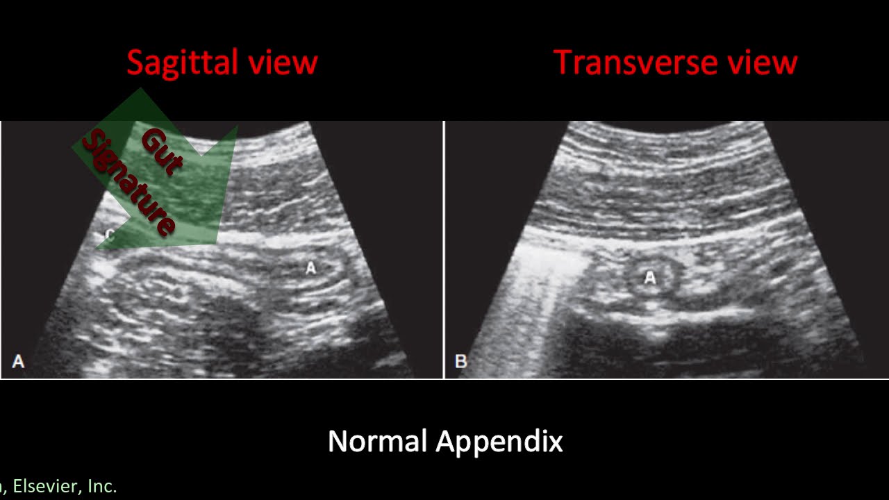 Gut signature in Appendicitis II Sonographic diagnosis II Dr Nasrin ...