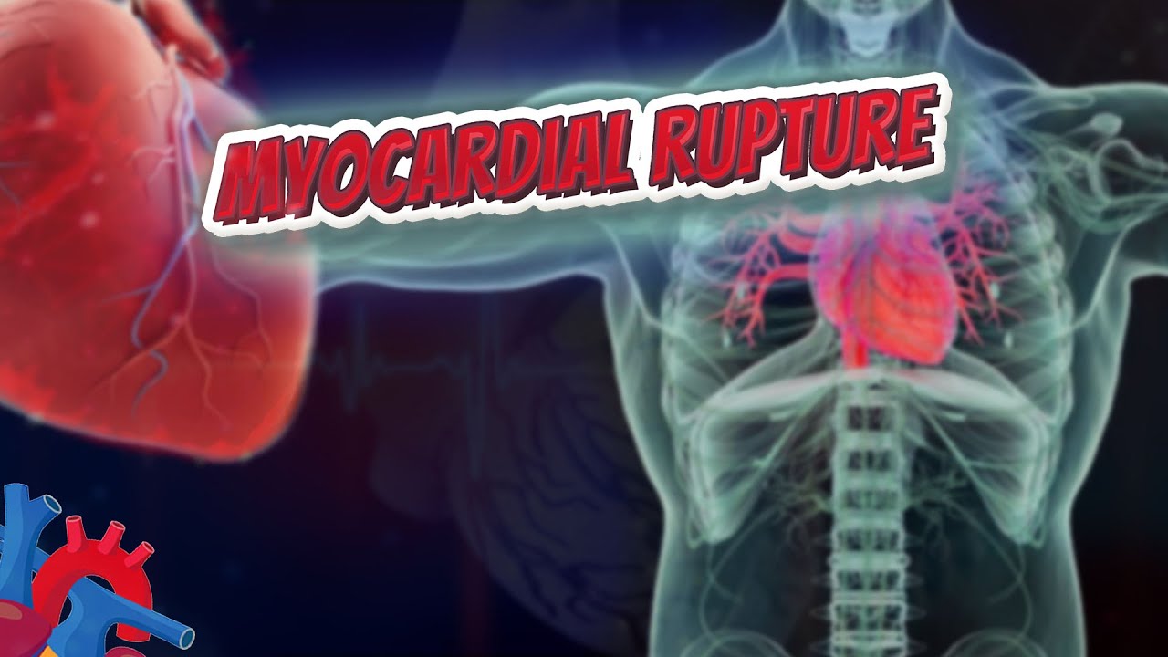 Myocardial rupture - Human Heart ️ and Cardiology ️🔊 - YouTube