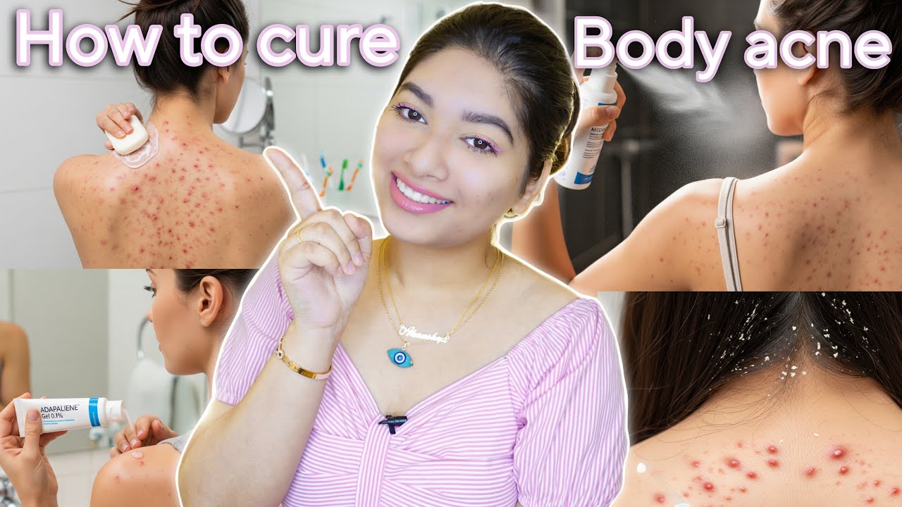 How to get rid of body acne fast | Backacne | Medic Akanshya - YouTube