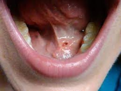 sialodochoplasty CPT code - simplify medical coding - YouTube