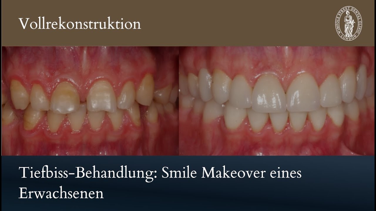 Tiefbiss-Behandlung: Smile Makeover eines Erwachsenen - Fall des Monats ...