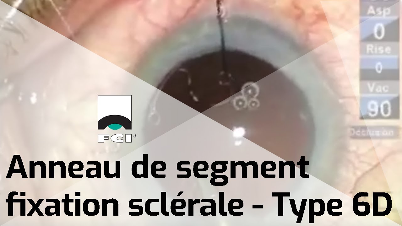 Anneau de segment pour fixation sclérale Morcher - Type 6D | Cataracte ...