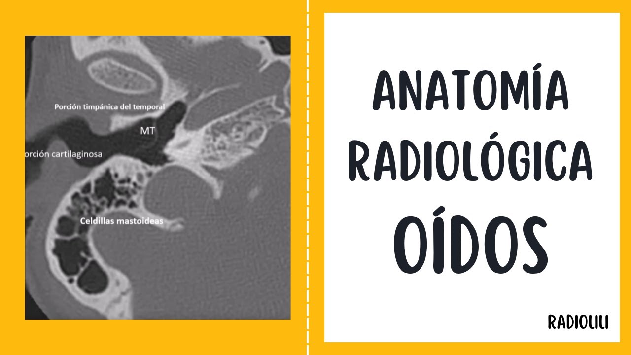 Anatomía Radiológica - Tomografía Computarizada: Oídos. - YouTube