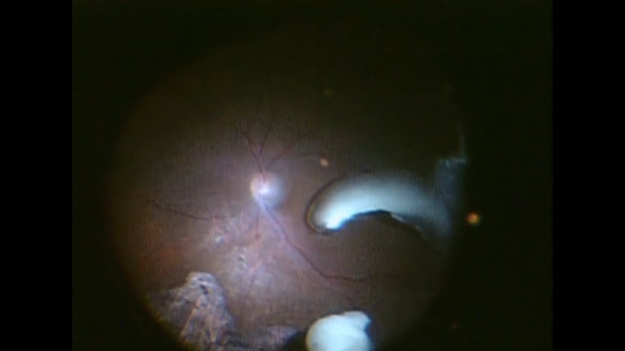 23 gauge Removal of Retained Lens Fragments - YouTube