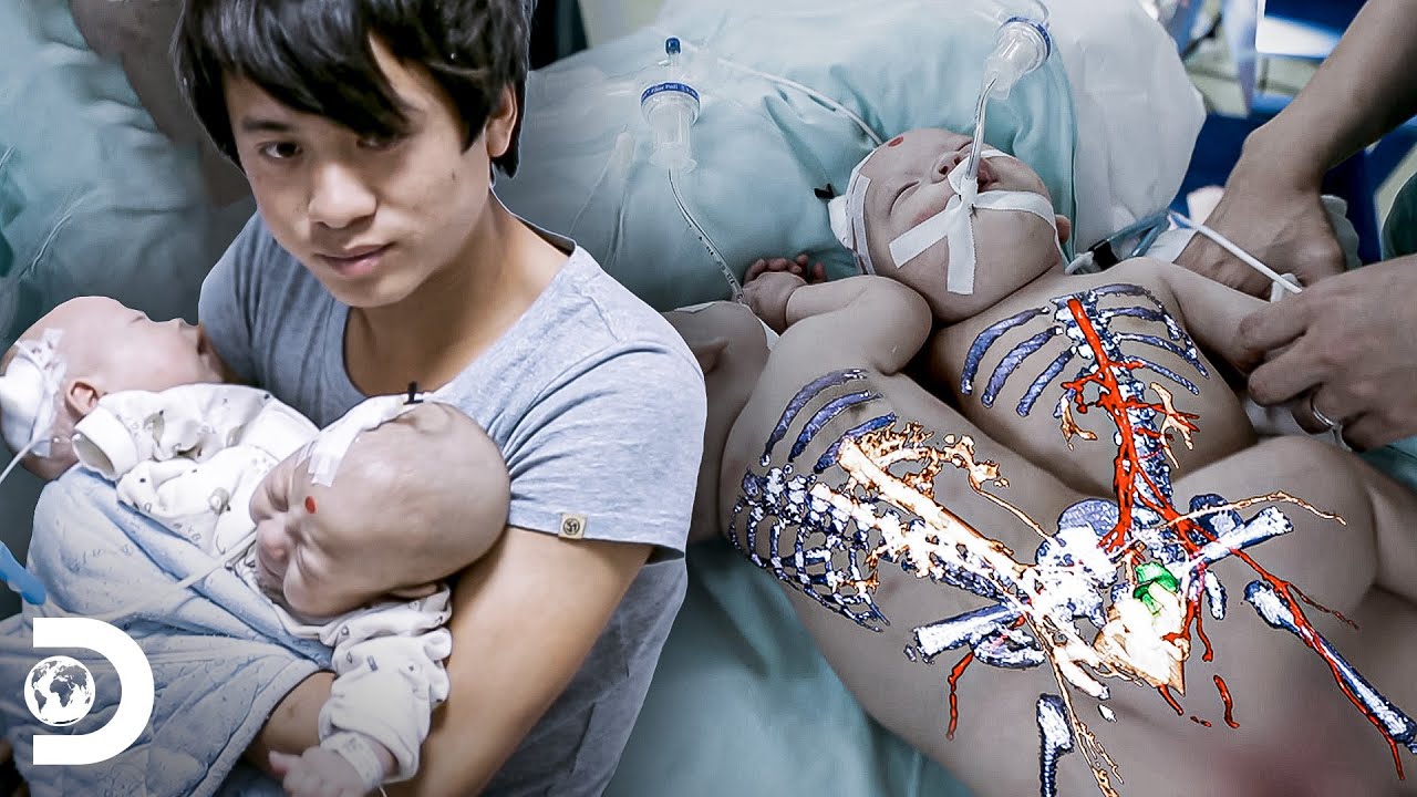 Gêmeos siameses que compartilham o fígado | Meu Corpo, Meu Desafio ...