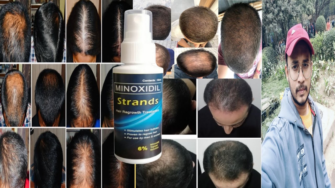 minoxidil strands hair regrowth treatment | honest review - YouTube